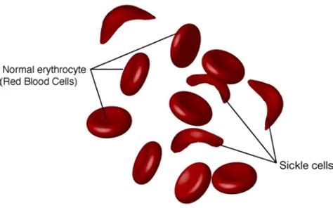 10 Interesting Sickle Cell Anemia Facts My Interesting Facts