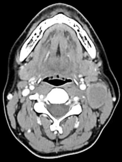 Follicular Dendritic Cell Sarcoma An Uncommon Lymphatic Neoplasm Eurorad