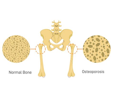 Osteoporosis Treatment Therapy Symptoms Causes QI Spine