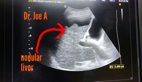 Liver Cirrhosis Ultrasound Images