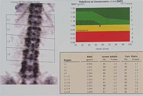 Densitometria óssea Dimen Medicina Nuclear