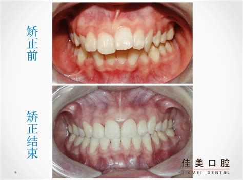 龅牙女生矫正，收获柔和面部线条 贝致案例库 贝致——专业口腔服务平台，权威医生，真实案例，一次看够