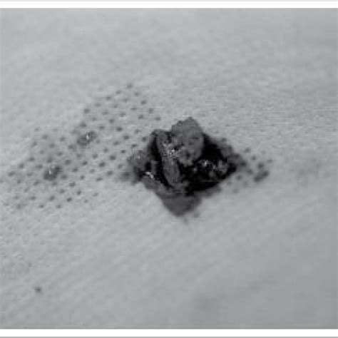 Pdf Oral Myiasis Case Report