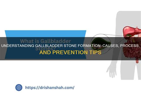 Understanding Gallbladder Stone Formation Causes Process And