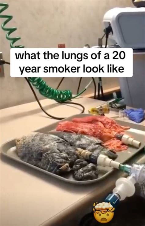 Terrifying Footage Shows Breathing With A Normal Lung Compared To A