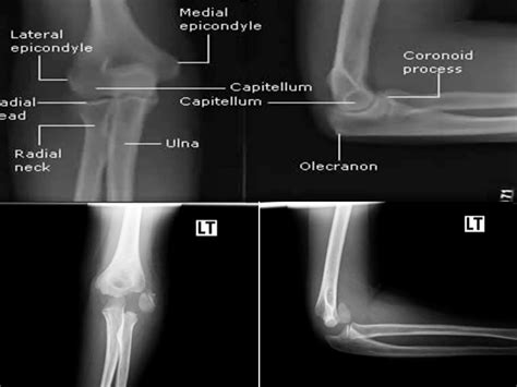 Case Discussion Lateral Condyle Fracture Pptx