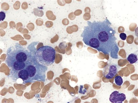 Multinucleated Plasma Cells Multiple Myeloma Stock Illustration Illustration Of Myeloma