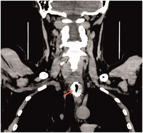 Computed Tomography Scan Of Esophagus Showing An Impacted Foreign