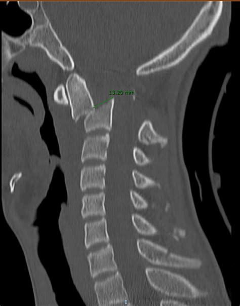 Odontoid Fracture