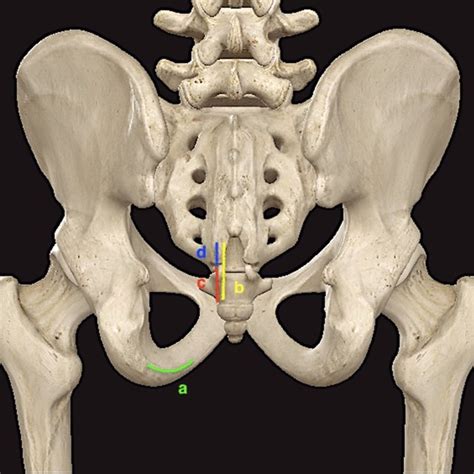 3d Simulation Of Infragluteal Fold Yellow Color From Bony Attachments