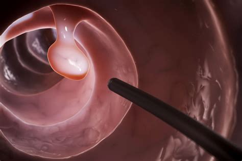 Colonoscopy Examination Of The Colon MyDr Com Au