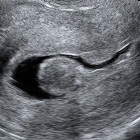 Uterine Cancer Ultrasound Images