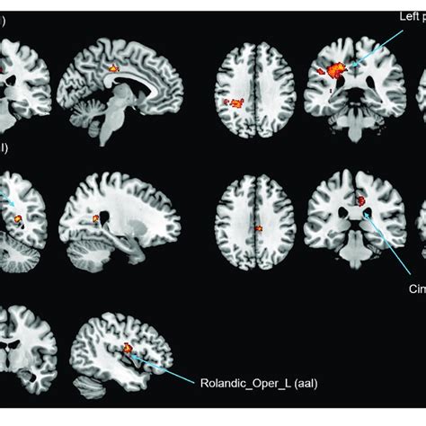 Intergroup Differences In The Inter Network Functional Connectivity