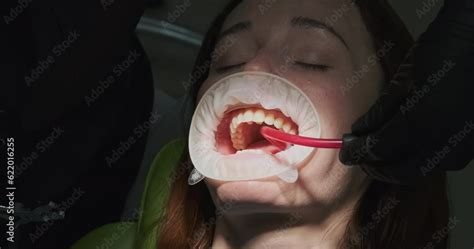 Dentist Takes Saliva Of Patient With Saliva Ejector Orthodontist