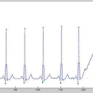 QRS Complex Detected Shown On Original Signal Download Scientific Diagram