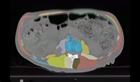Specific Muscle Segmentation Support 3d Slicer Community