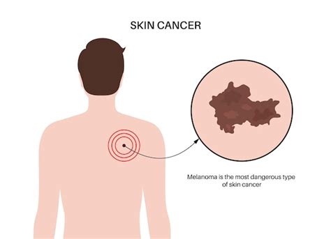 Vecteurs Et Illustrations De Cancer De La Peau En Téléchargement