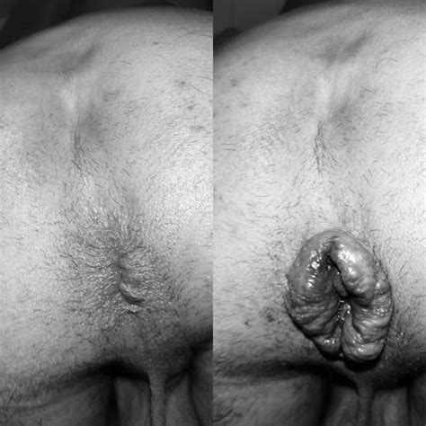 Foto De Before After