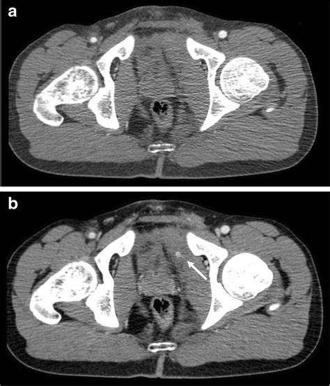 No Findings Of Extravasation In Arterial Phase Ct A Extravascular