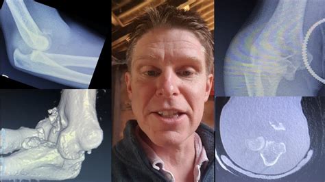 Case Takeaway Wrightington Elbow Fracture Dislocation Classification