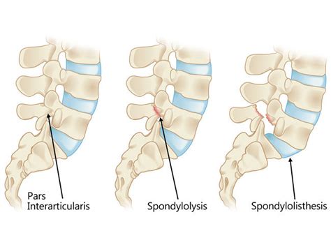 How To Manage A Spondylolisthesis With Exercise