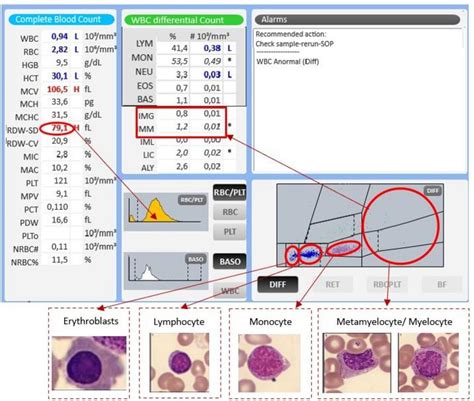 Chase The Case 17 Acute Promyelocytic Leukemia