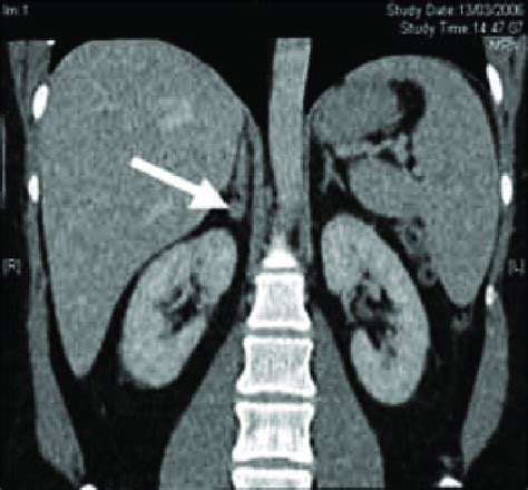 Conns Adenoma In The Adrenal Gland Mri Scan Of Patients With High