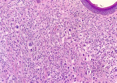 Xanthomas Histology