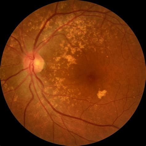 Github Hannah Swjocular Disease Classifier