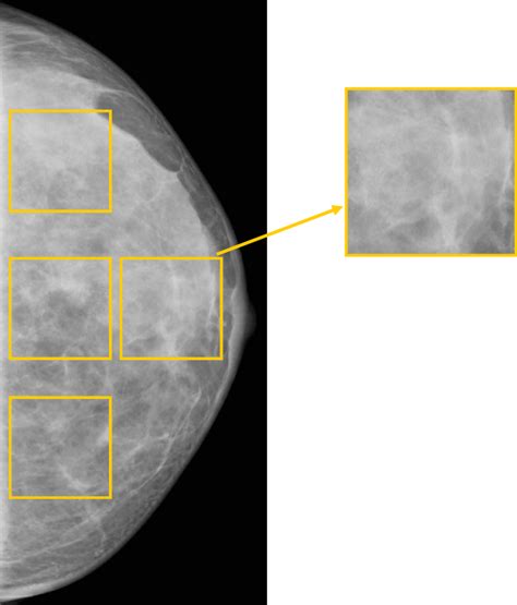 Figure 3 From Evaluation Of An Improved Algorithm For Producing Realistic 3d Breast Software