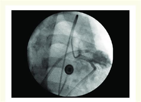 Selective Angiography Of The Left Coronary Artery And Left Atrial Download Scientific Diagram
