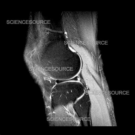 Normal Mri Knee