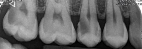 Caries Instance Segmentation Dataset By Begad