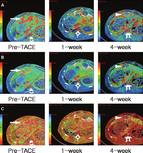 Transverse Ct Perfusion Maps Of Bf A Bv B Mtt C Ps D And Download Scientific