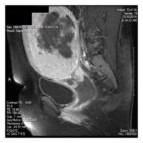 Mri Showing A Large Central Necrotic Fibroid Download Scientific Diagram