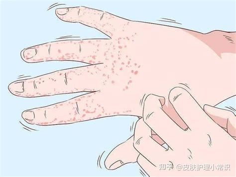 深圳肤康皮肤病专科：春季如何预防高发的皮肤病？ 知乎