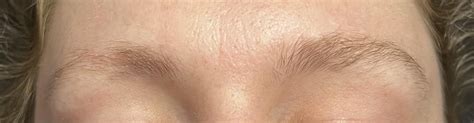 Eyebrow Rash And Bald Spots Any Treatmentsadvice R