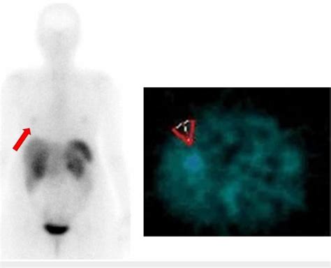 Showing Slight Metabolic Activity Located In The Basal Medial Segment