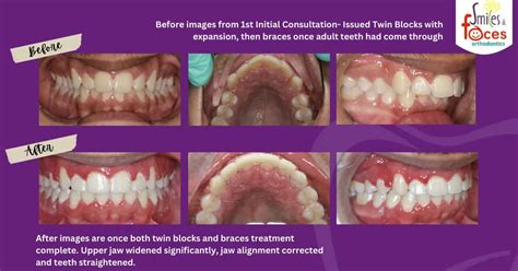 Benefits Of Twin Block