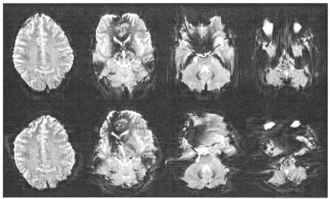 Demonstration Of Epi Distortion Selected Epi Brain Slices Taken With Download Scientific