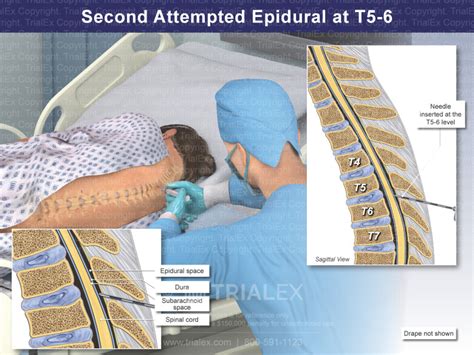 Second Attempted Epidural At T5 6 Trialquest Inc