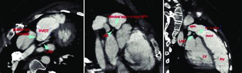 A C Multi Slice Computed Tomography Image Relation Of Proximal Left Download Scientific
