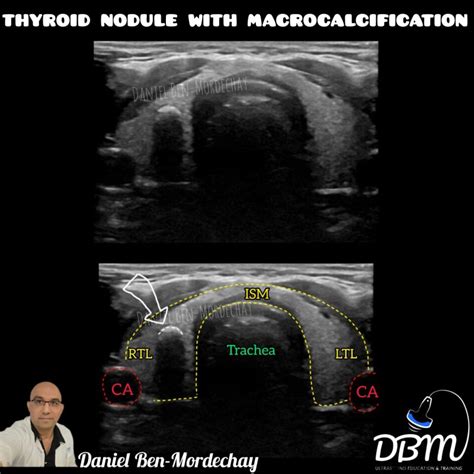 Understanding Thyroid Nodules With Calcification On Ultrasound Daniel