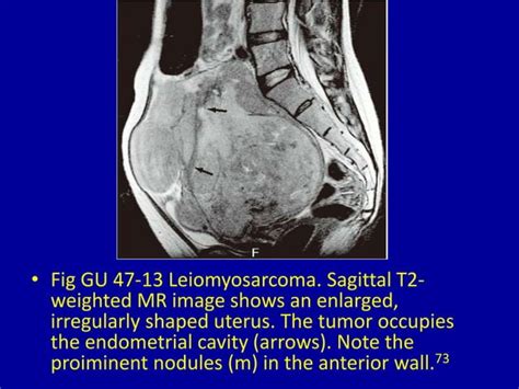 47 Diffusely Enlarged Uterus On Magnetic Resonance Imaging Ppt