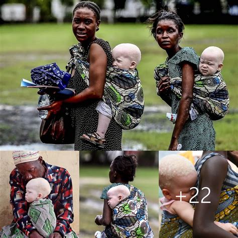 Albino Twins Born To Black Mother Draw Attention With Striking White