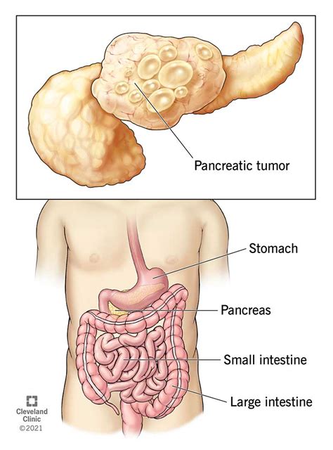 Pancreatic Cancer Symptoms Causes Treatment 52 Off
