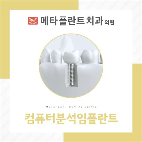 메타플란트치과 안녕하세요 메타플란트치과의원입니다~ 컴퓨터분석임플란트는 적은 절개로 진행되기 때문에