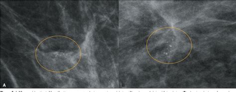 Figure 1 From Amorphous Breast Calcifications Is Bi Rads 4a Appropriate Semantic Scholar