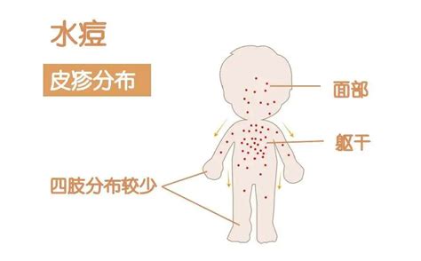 冬季水痘进入高发期预防方法你都知道吗