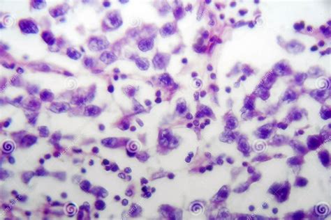 Seminoma Testicular Micrografía Ligera Imagen De Archivo Imagen De